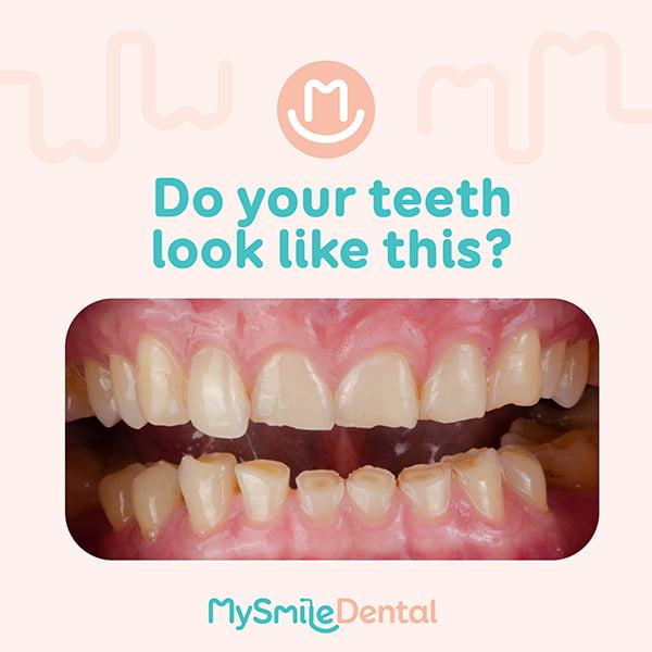 Bruxism Teeth Grinding Facts Mysmile Dental Clinic